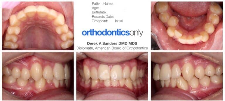 Miami Orthodontist Explains Scissors Bite Malocclusion