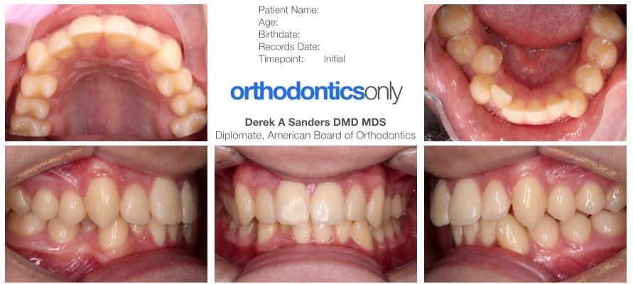 Miami Orthodontist Explains Scissors Bite Malocclusion