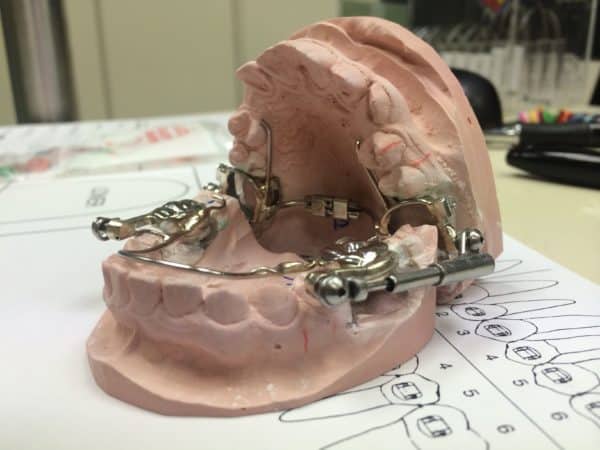 Miami Orthodontist Explains Overbite Correction Methods