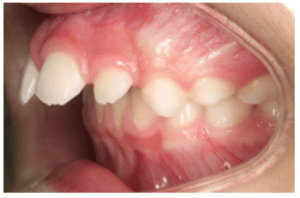 Early Treatment for Buck Teeth Can Prevent Trauma