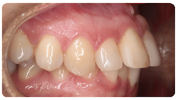 Miami Orthodontist Explains Scissors Bite Malocclusion